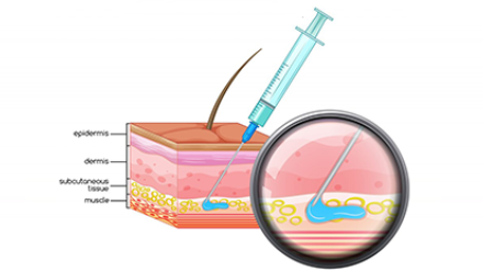 Subcutaneous Drug Administration: Effective Medication Deliver